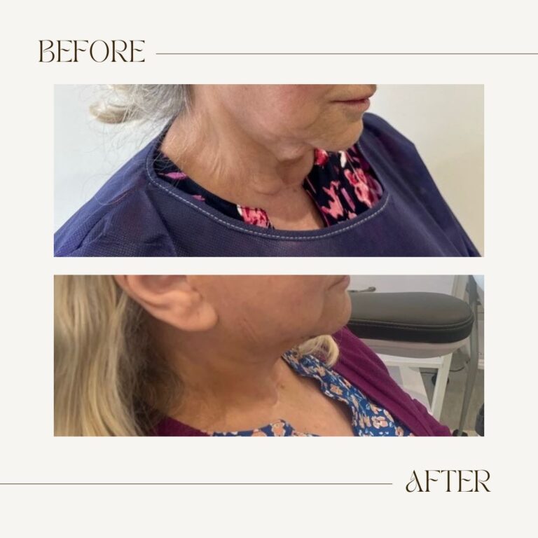 Chin Tuck: Transform Your Jawline in Essex