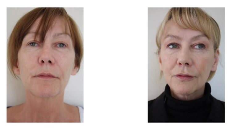 Permanent Thread Lift for Youthful Skin in Essex