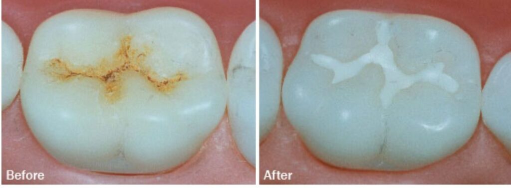 Fissure Sealant: Protect Your Teeth from Cavities