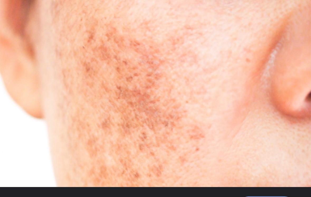 Sunspot Treatment Options for Aesthetic Improvement - JR Medical